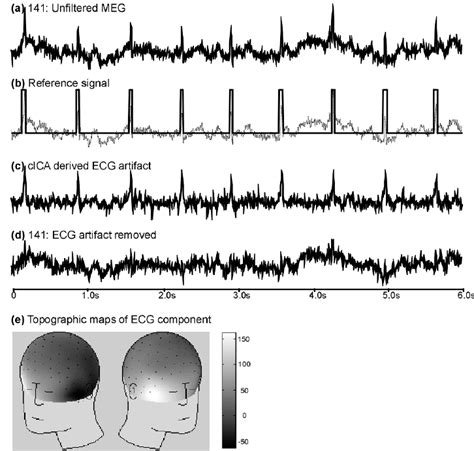 Rejection Of A Meg Artifact Using The Cica Algorithm Download