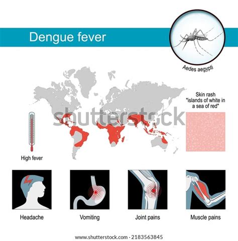 뎅기열 증상 인포그래픽과 인식 포스터 전염병 스톡 벡터로열티 프리 2183563845 Shutterstock