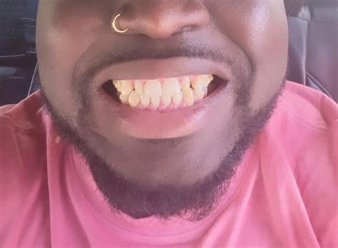 Questions For Refinement R Invisalign