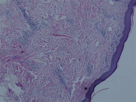 Chronic Lipodermatosclerosis In A Young Male Patient Selçuk Tıp Dergisi