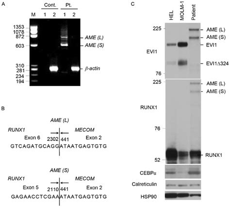 Analyses Of Ame Fusion Transcripts And Proteins In The Leukemic Cells