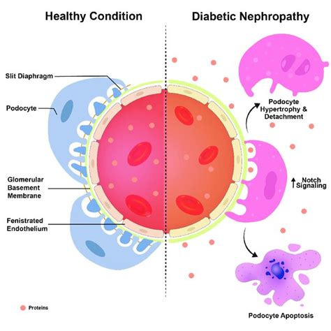 Comparative Illustration Of Podocytes During Health And Disease Dn Download Scientific