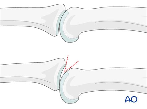 Dislocation Of The Proximal Interphalangeal Joint