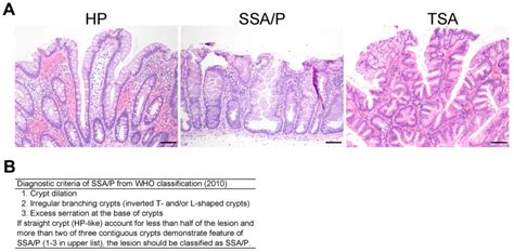 Hyperplastic Polyp Gi Histology Week 3 Studyblue Hyperplastic Polyp Gi Histology Week 3 Studyblue