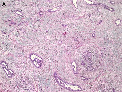 Cholangiocarcinoma Pathology Outlines