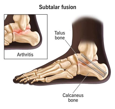 Subtalar Fusion Surgery Procedure And Recovery Wockr