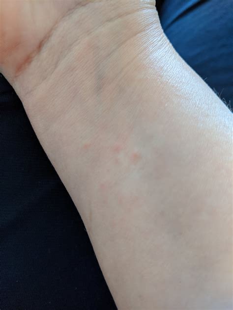 Stress Rash On Arms