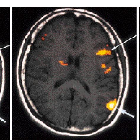 Functional Mr Images Obtained During Noun Generation Task In A Right Download Scientific