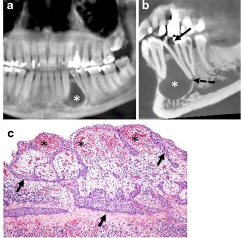 Radicular Cyst A Opt Unilocular Radiolucent Lesion With