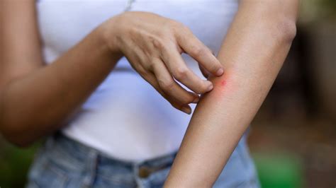 How To Get Rid Of Arm Acne Causes Treatments And Prevention Tips
