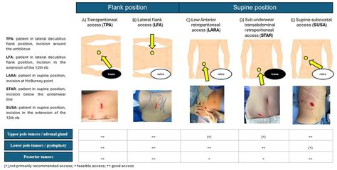 Advances In Retroperitoneal Access For Robotic Surgery European