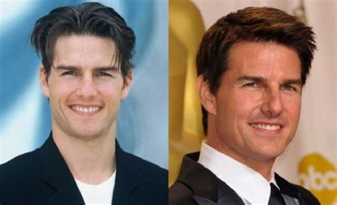 Tom Cruise Before And After Plastic Surgery Face Nose Teeth