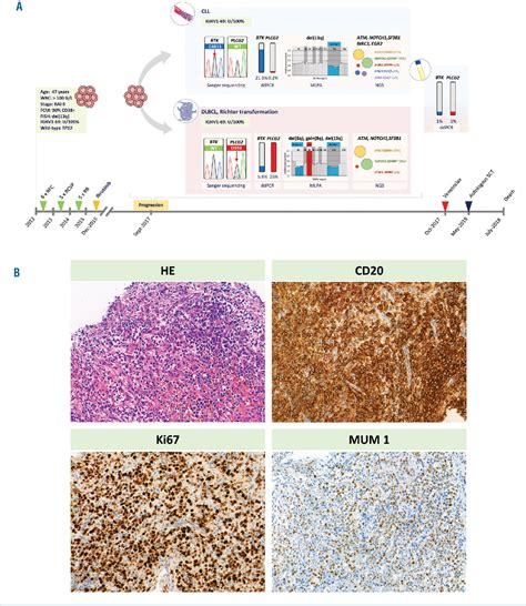 figure 1 from spatial clonal evolution leading to ibrutinib resistance