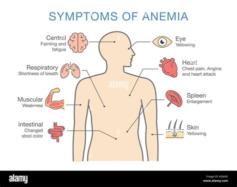 Iron Deficiency Anemia Eyes Iron Deficiency Anemia Eyes