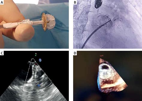 Percutaneous Left Atrial Appendage Closure Using The Lambre Device