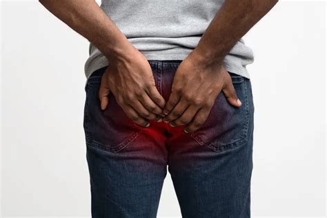 What Are My Treatment Options For Anal Warts Colon And Rectal Surgeons And Proctologists In