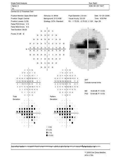 Visual Field Defects Chart Ponasa