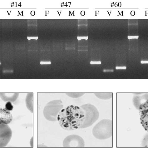 A Diagnosis Of Plasmodium Ovale By A Nested Polymerase Chain Reaction Download Scientific