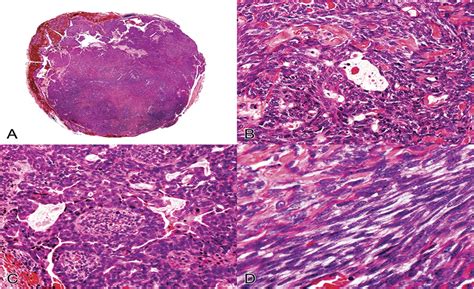 Primary Subcutaneous Synovial Sarcoma First Reported Subcut The American Journal Of