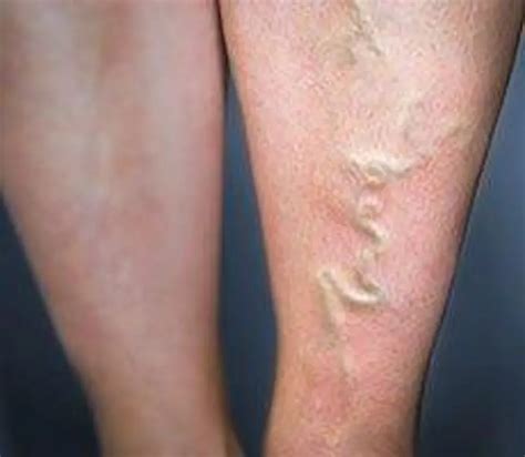 Varicose Veins For Plano And Mckinney Tx Heart And Vascular Care Board Certified
