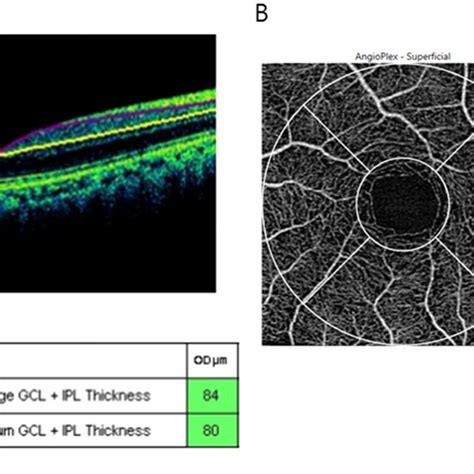 The Thickness Of The Ganglion Cell Inner Plexiform Layer Gc Ipl Using Download Scientific