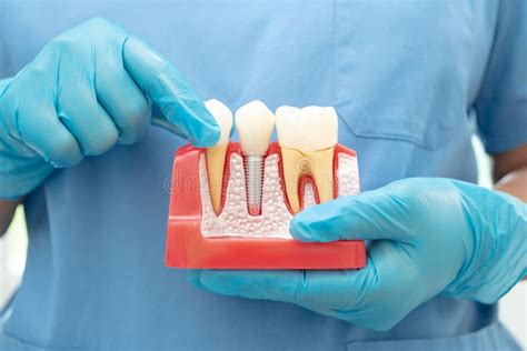 Dental Implant Artificial Tooth Roots Into Jaw Root Canal Of Dental
