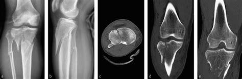 Tibia And Fibula Proximal Metaphyseal Simple Fracture—41 A2