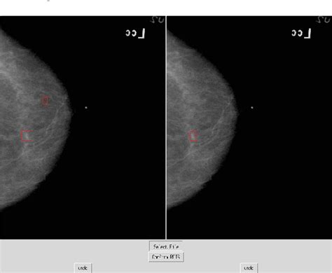 Figure 3 From Mammogram Based Cancer Detection Using Deep Convolutional Neural Networks
