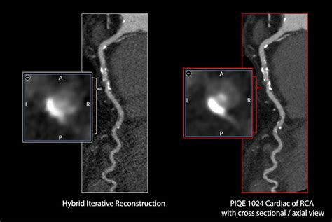 Piqe Ai Deep Learning Reconstruction Computed Tomography Ct Scanners Canon Medical