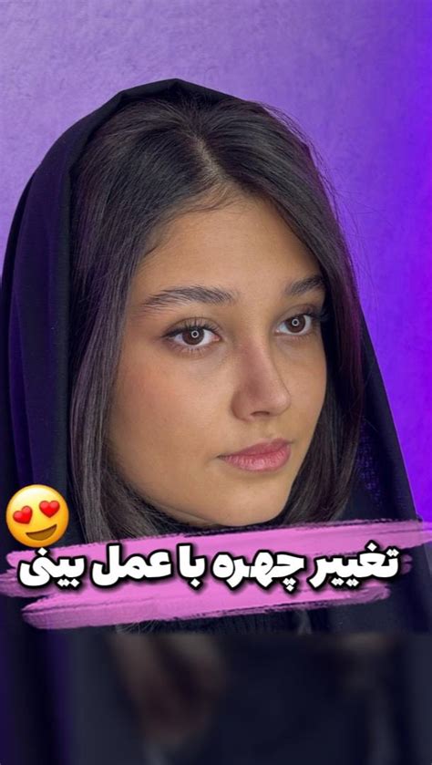 ‎جراحی بینی بینی گوشتی بینی نیمه فانتزی‎ ‎عمل بینی با نتیجه عالی