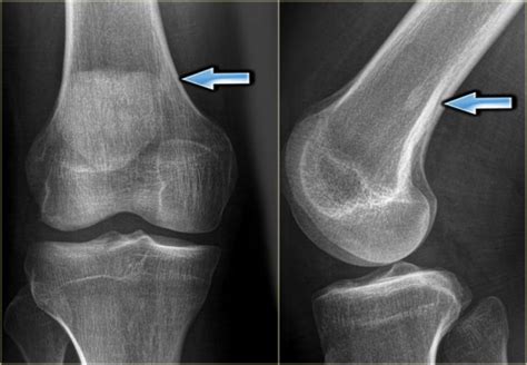 The Radiology Assistant Sclerotic Bone Tumors