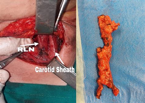 Prophylactic Central Neck Dissection For Papillary Thyroid Carcinoma