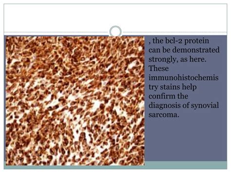 Synovial Cell Sarcoma Dr Narmada Pptx Bone And Joint Conditions
