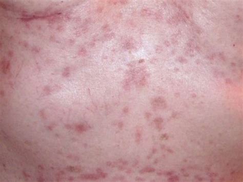 Papular Eczema Symptoms Causes And Treatment Artofit