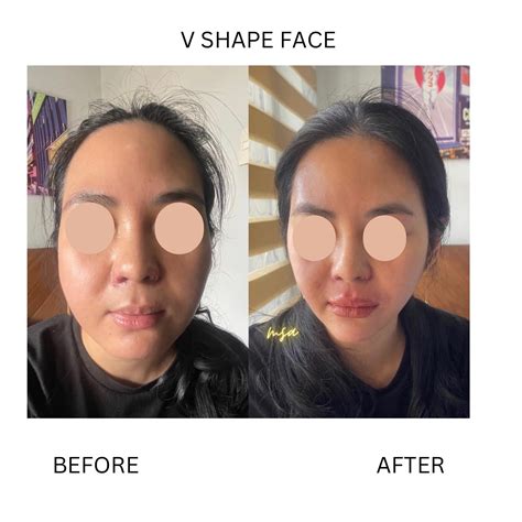 Jawtox Jawline Gluta Glow Hub And Aesthetics By Ms A