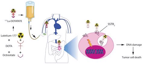 Neuroendocrine Tumors Nets The Significance Of Somatostatin Receptor Ssrt For Diagnosis And