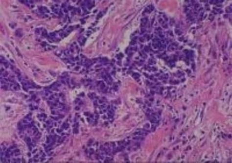 Novus Biologicals™ Human Breast Tissue Microarray Cancer Human Breast