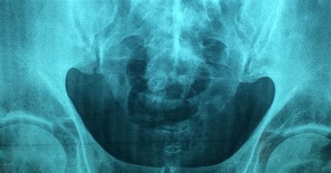 Radiographie Osseuse