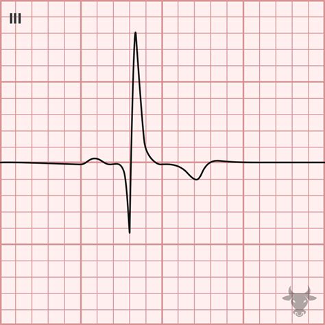 Pulmonary Embolism Ecg Stampede