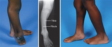 Tibial Hemimelia Tibial Deficiency Orthoinfo Aaos