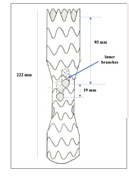 Fenestrated And Branched Aortic Endografts Vdm