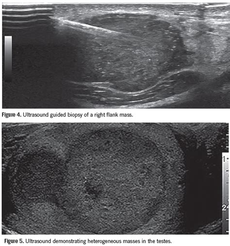 Multiple Cutaneous Nodules In A Previously Healthy Male Consultant360