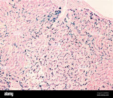 Light Micrograph Of A Liver Biopsy Stained With Perls Prussian Blue