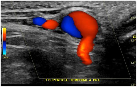 Nightmare Accident Leads To Superficial Temporal Artery Aneurysm