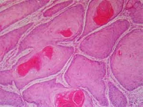 Ulceration With Invasion Of Malignant Keratinizing Squamous Cells Download Scientific Diagram
