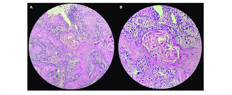 Pathological Tissues Of Oscc Patients Based On Hematoxylin Eosin