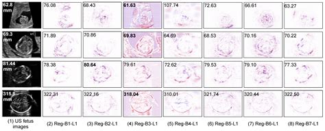 Segmentation Based Vs Regression Based Biomarker Estimation A Case