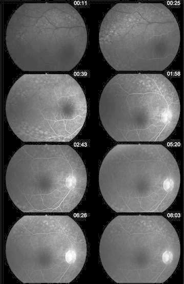 Fa Of Right Eye With Crao Images Obtained 1 Day After Presentation Download Scientific Diagram