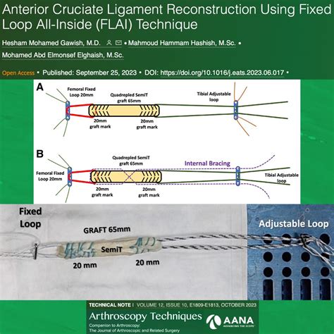 Acl Sports Arthroscopy Arthroscopy Journals
