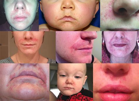 Mild Periorbital Dermatitis